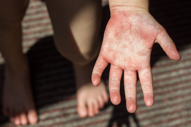 Scarlet fever in children