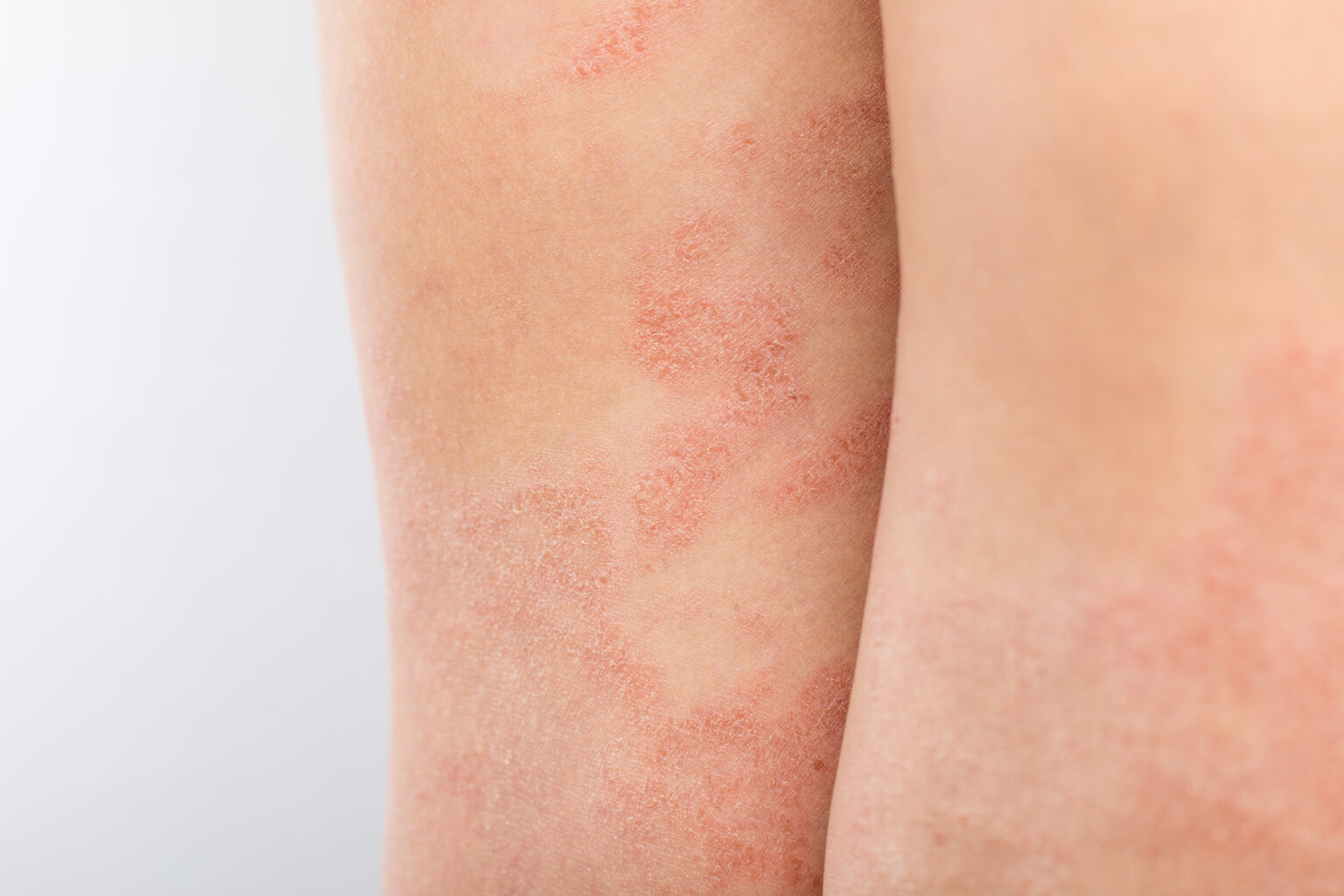Eczema In Babies and Children | London Paediatrician