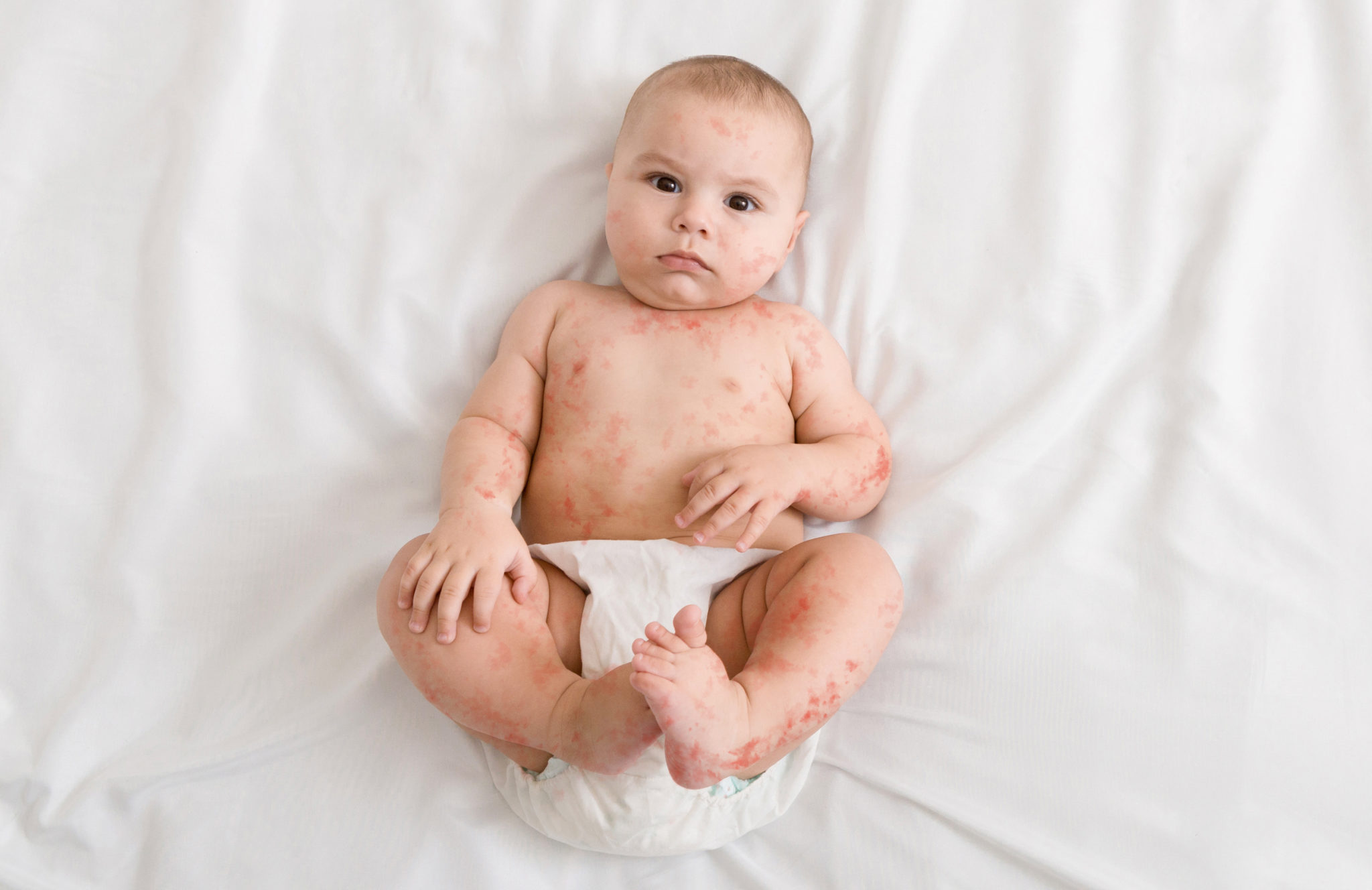Measles In Babies: What To Look Out For | Childhealthy London