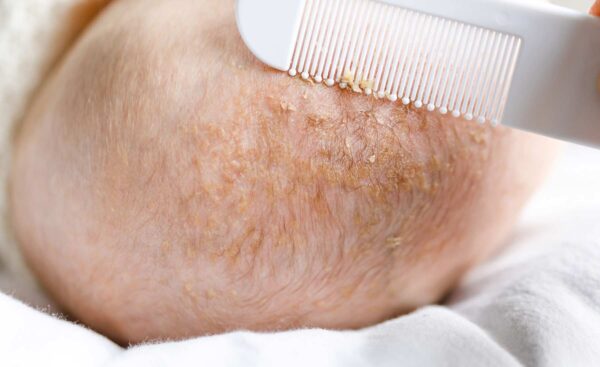 What is the best treatment for cradle cap?